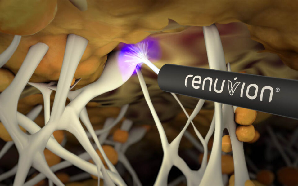 Renuvion • Dr n. med. Osipowicz