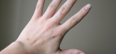 Bostonka (choroba bostońska) - objawy, leczenie