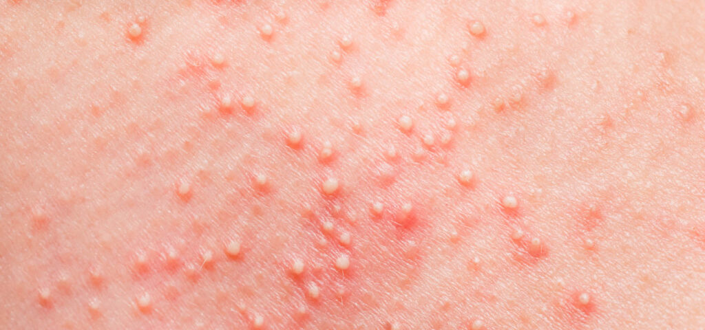 Wysypka na dłoniach i stopach — poznaj rodzaje i przyczyny